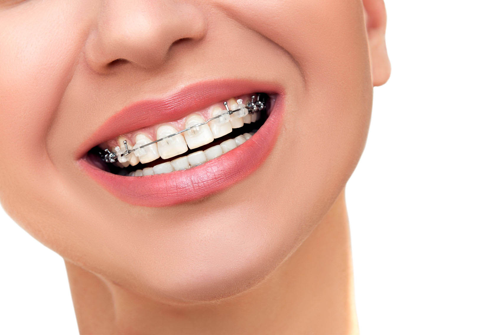 Retainer Instructions Smile Suffolk Braces Suffolk VA Orthodontist Retainer Instructions Smile Suffolk Braces Suffolk VA Orthodontist